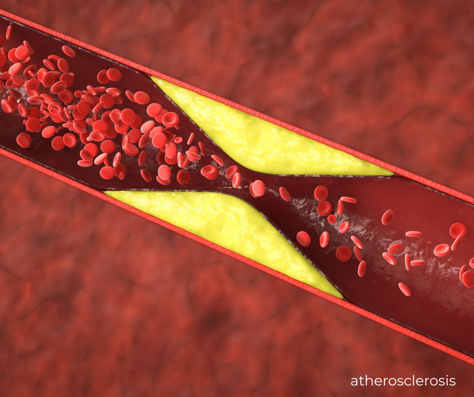 Inflammation, cholesterol, and lipoprotein a predict heart outcomes in ...